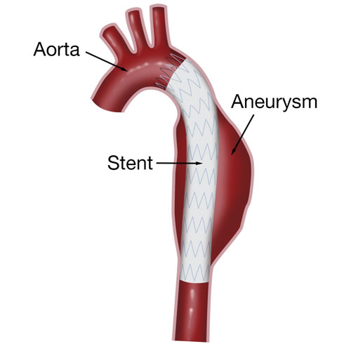 Unfolded Aorta Meaning